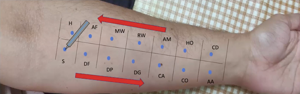 Skin Prick Testing – CENTRE FOR CHILD HEALTH, BLKMAX SUPER SPECIALITY ...