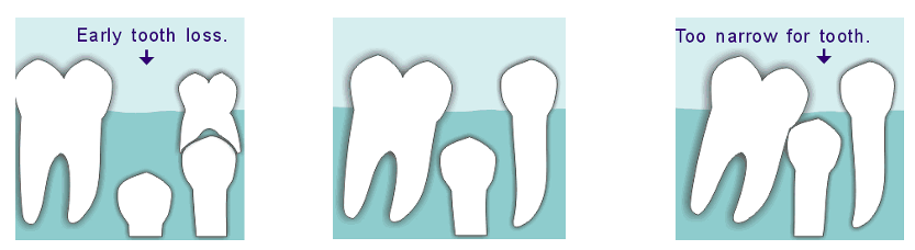 ARE PRIMARY TEETH REALLY THAT IMPORTANT ?! – CENTRE FOR CHILD HEALTH ...
