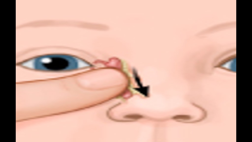 Management of nasolacrimal duct obstruction – CENTRE FOR CHILD HEALTH ...