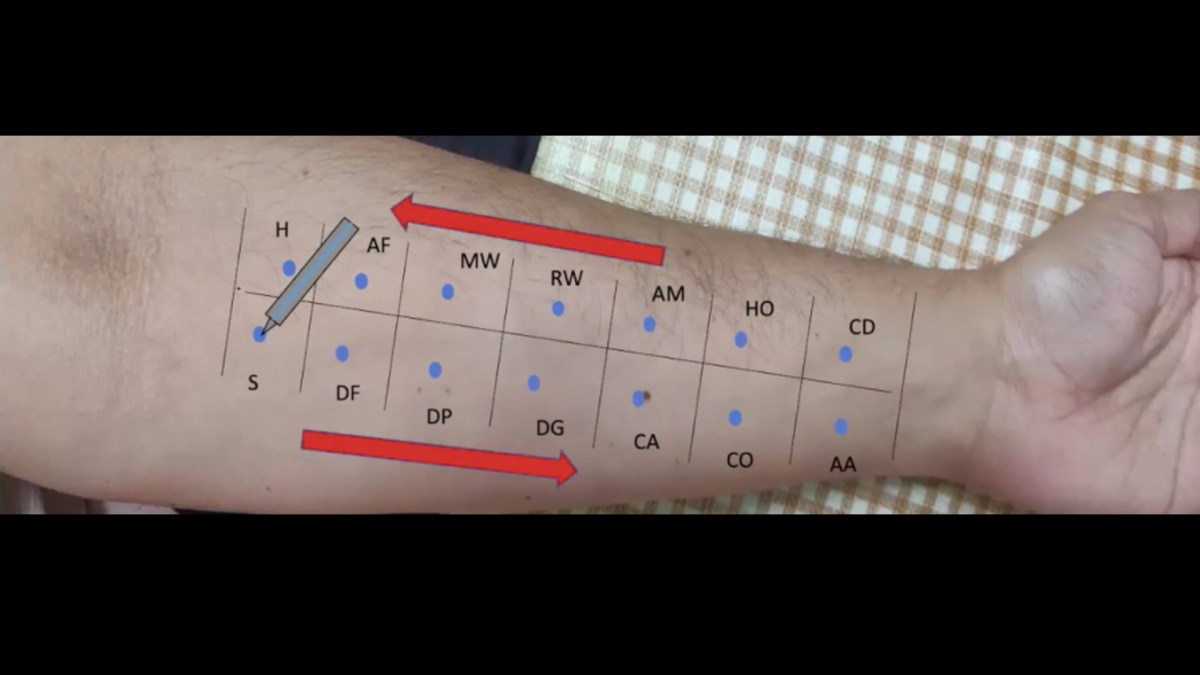 Skin Prick Testing- when to plan – CENTRE FOR CHILD HEALTH, BLKMAX ...